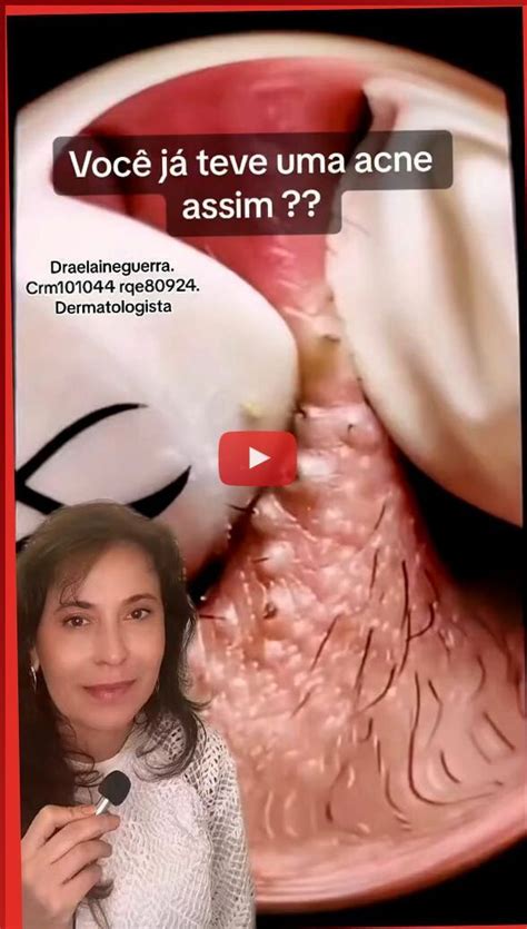 Pin On Ear Pimple