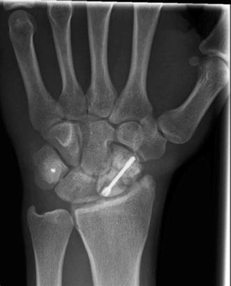 Scaphoid Fracture X Ray At Rebecca Rodriguez Blog