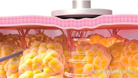射频热疗能为你带来什么 知乎