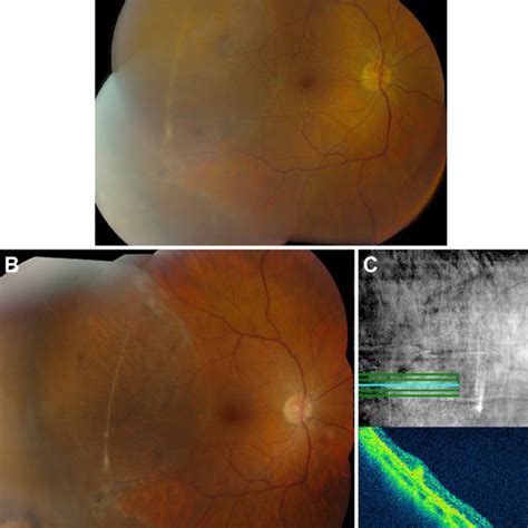 Fundus Photography And Sd Oct Imaging Case 3 Notes A Preoperative