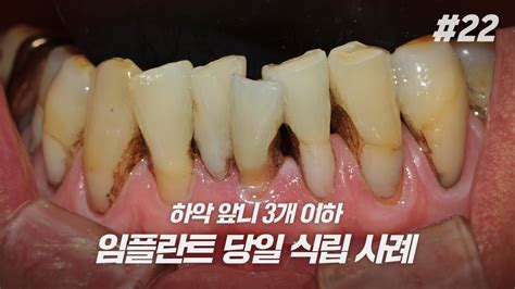 60대 환자의 하악 앞니 3개 이하 당일 임플란트 치료 사례 YouTube