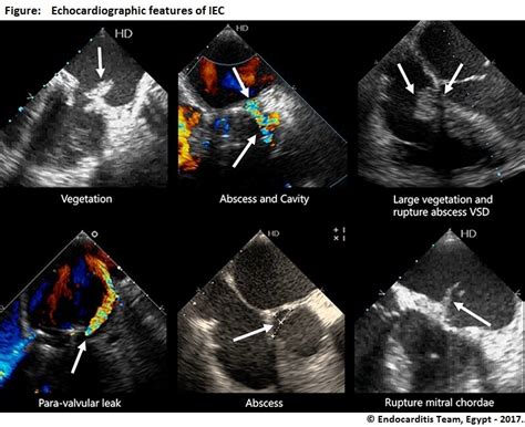 Pdf Echocardiography The Crystal Ball Of Infective Endocarditis Management In Rheumatic