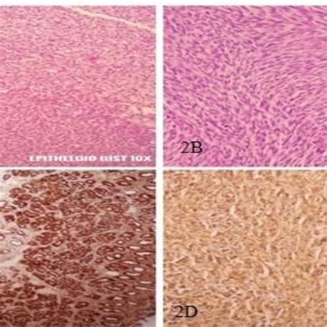 A 10x Epithelioid Variant Of Gist Showing Sheets Of Epithelioid Cells