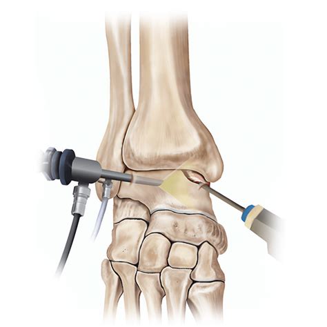 Ankle arthroscopy CLLC Montréal Dre Marie Gdalevitch