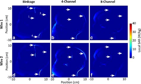 Local SAR For Bilateral Implanted Wires Local SAR For Wire In Download Scientific Diagram