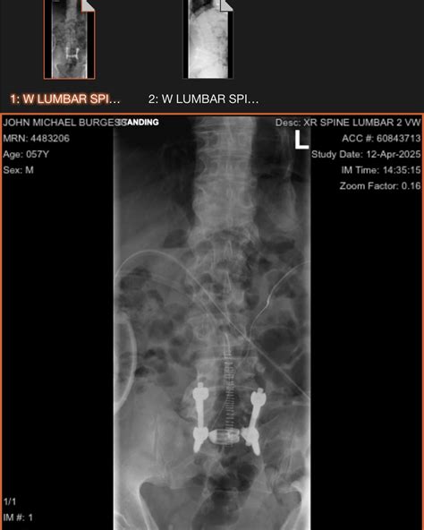 Restoration X Cycles I Made It Through Four Hours Surgery My Foot Feels Better Already Just