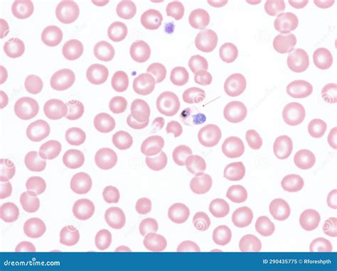 Gametocyte Of Plasmodium Falciparum In Peripheral Blood Royalty Free