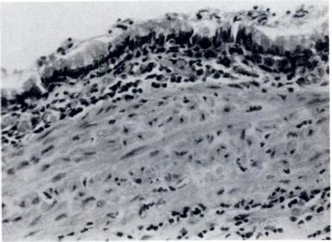 Gastric Duplication Cyst Lined By Single Layer Of Simple Columnar Download Scientific Diagram