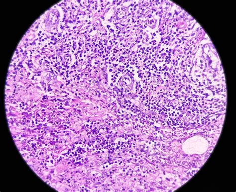 Pilonidal Sinus Laser Treatment Apex Hospitals