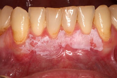 Proliferative Verrucous Leukoplakia