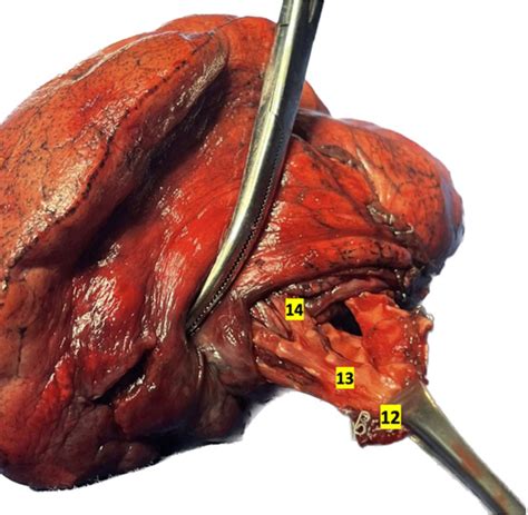 Figure 1 From Standardized Intrapulmonary Lymph Node Dissection In Lung Cancer Specimens A