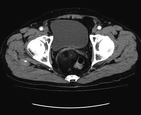 Pelvic Ct Shows Fatty Density Retroperitoneal Tumor In The Prerectal Download Scientific