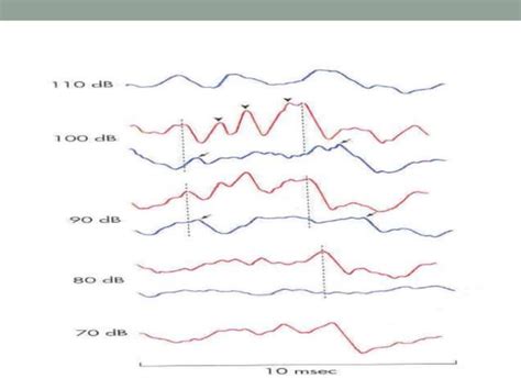 Oae And Bera Otoacoustic Emissions And Brainstem Evoked Response