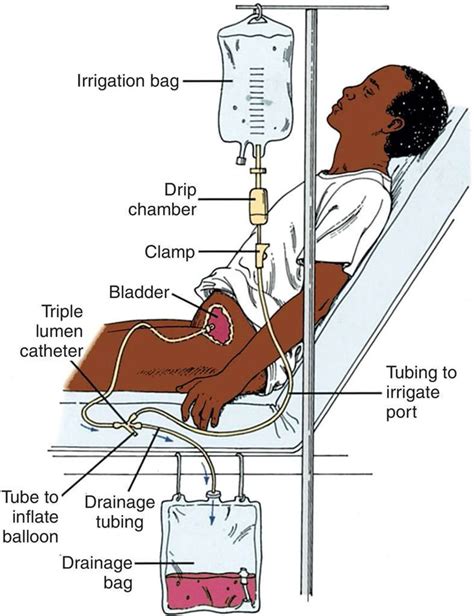 Urinary Bladder Irrigation