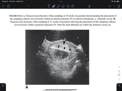 Obgyn Chapter 55 Flashcards Quizlet
