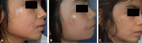 Excimer Laser Treatment For Morphea Lichen Sclerosus Et Atrophicus Overlap In A Pediatric