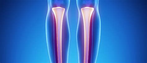 Patient Specific 3d Printed Titanium Implant For Distal Tibial Critical