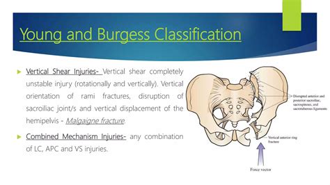 Pelvis Fracture Dislocation Pptx
