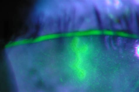 Herpes Simplex Keratitis Guide To Diagnosis And Treatment Mivision