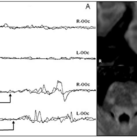 Trigeminal Blink Reflex And Brainstem Mri Of A Patient With Ablat N 6 Download Scientific