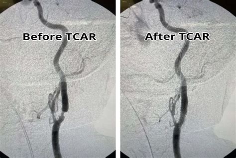 Transcarotid Artery Revascularization Tcar Southern California Multi Specialty Center
