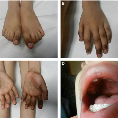 Reticular Pigmentation And Skin Atrophy Was Visible On Both Thighs