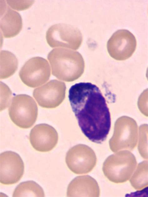 M2 Aml With Basophilia Fab