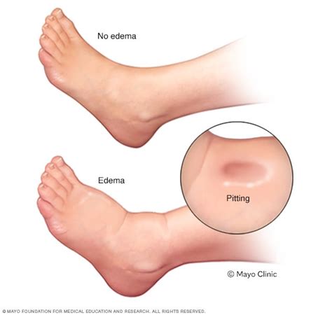 Edema Swelling Of Feet And Legs Dr Segals