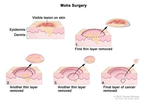 Soft Tissue Sarcoma Cardiothoracic Surgery