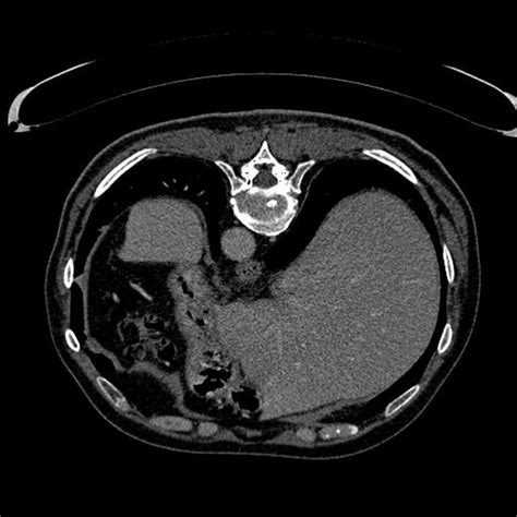 Liver Tumor Instance Segmentation Model By Reza