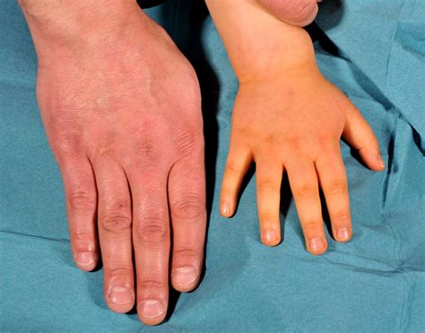 Lycopenemia