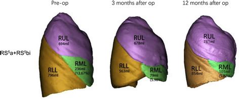 Thoracoscopic Right Middle Lobe Subsegmentectomy A Single Center