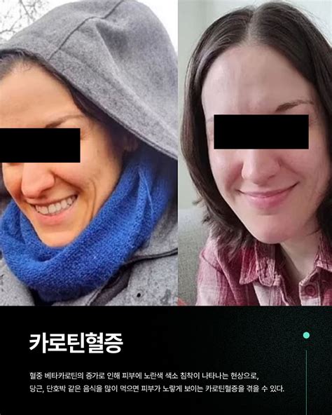 메디컬뉴스룸 Medicalnewsroom 얼굴을 노랗게 만든 음식 건강에는 이상 없었을까요💦 미국의 한 여성이 건강을 위해 매일 당근을 5개 이상 섭취했습니다