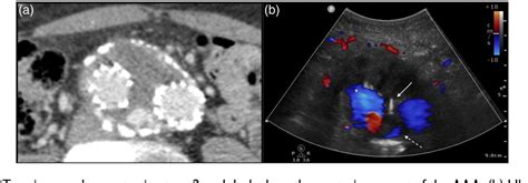 Figure 1 From Outcome And Technical Evolution Of Type 2 Endoleak