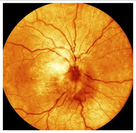 Figure 1 From A Case Of Bartonellosis Mimicking Systemic Lupus