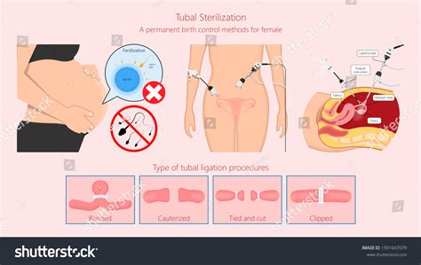 Tubal Ligation Mais De 196 Vetores E Artes Vetoriais Stock