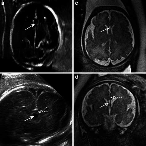 Normal Anatomy Of Csp In Utero A B Occipito Bregmatic And Coronal