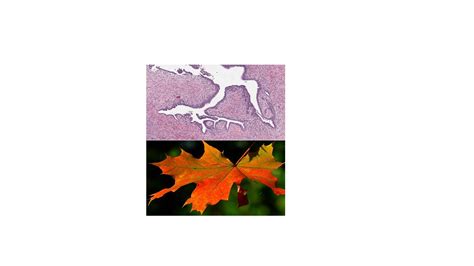 Phyllodes Tumor Pathology Made Simple