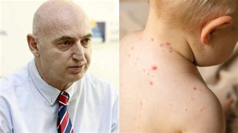 „ალბათ წლის განმავლობაში ჩუტყვავილას 10 ათასამდე შემთხვევა გვექნება“ ჩხაიძე განმარტავს რატომ