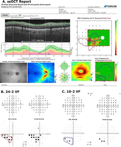 A Wide Field Ss Oct Report For An Eye Classified As Glaucomatous Download Scientific