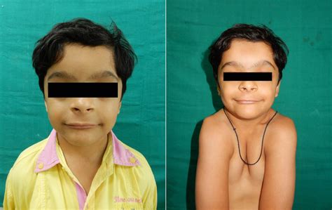 Characteristic Feature Of Ccd Patient Adduction Of Shoulders