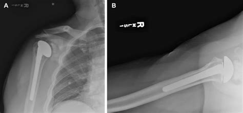 Final Postoperative Radiographs Showing Concentric Glenohumeral