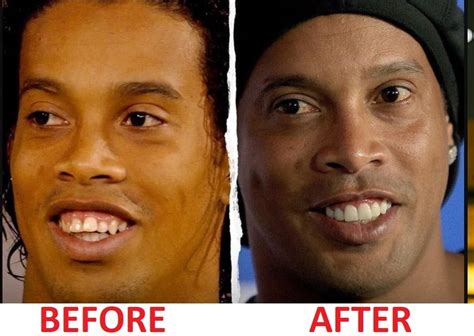 😁 I Denti Di Ronaldinho Gengive Modificate Porcellane Lema
