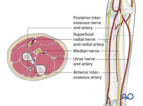 Compartment Syndrome Arm