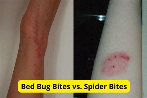 Bed Bug Bites Vs Spider Bites How To Tell Them Apart