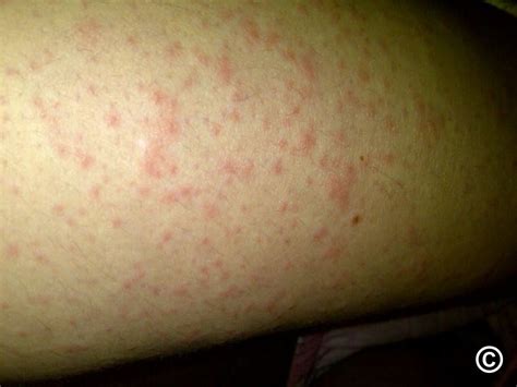 Rheumatoid Arthritis Rash Treatment