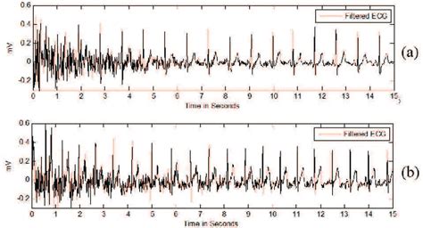 Figure 1 From Ecg Denoising With Adaptive Filter And Singular Value Decomposition Techniques