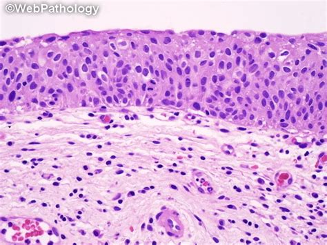 Urothelial Dysplasia