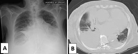 Basal Atelectasis X Ray