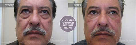 B And A Juvederm Ultra Under Eyes 64 Yo Concierge Aesthetics